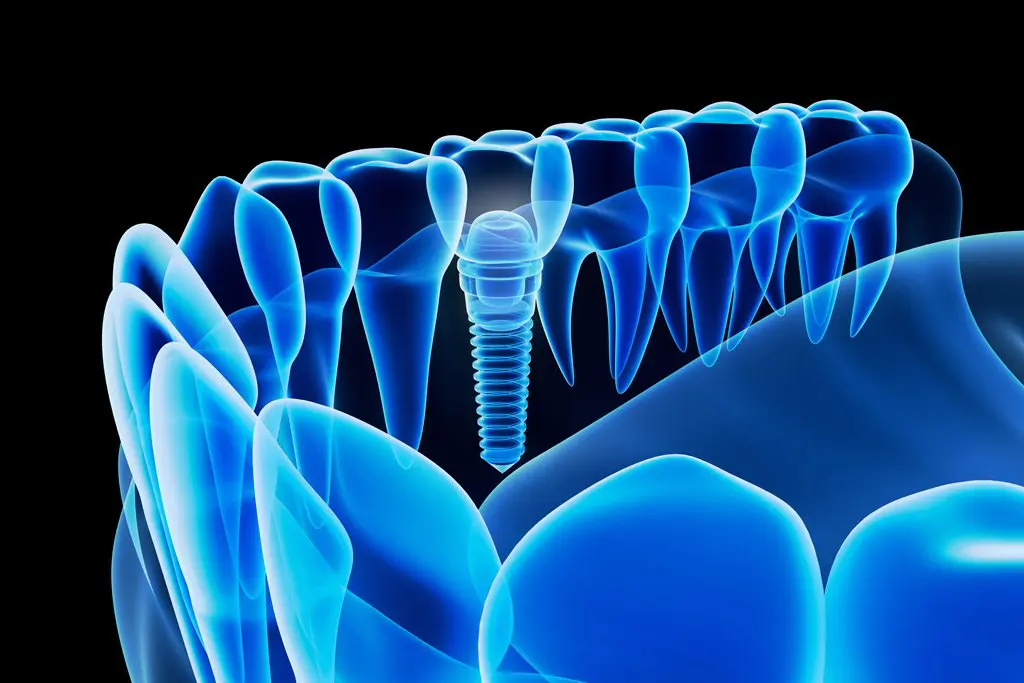 Dental Implants & MRI Safety: A Comprehensive Guide